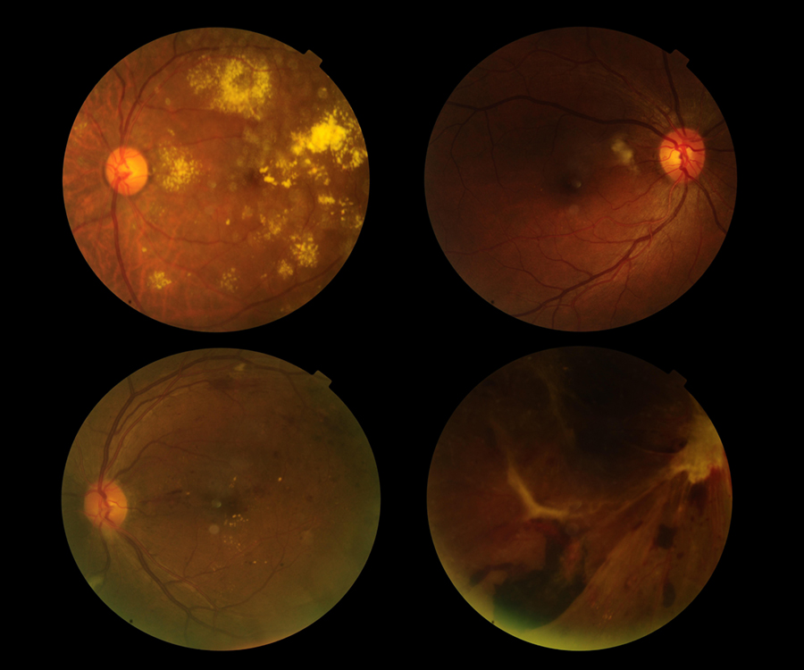 Eye Examination Louisville | Optomap Exam | VisionFirst Eye Care